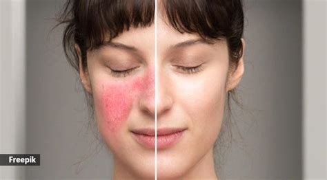 Does Chamomile Green Tea Work For Facial Redness Life Style News The Indian Express Does Chamomile Green Tea Work For Facial Redness Life Style News The Indian Express