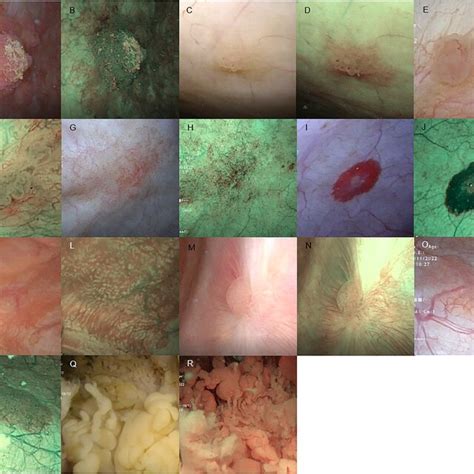 Illustration Of The Vascular Morphology Of The Bladder Mucosa By Nbi Download Scientific