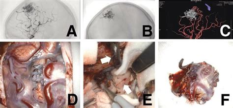 Preoperative Embolization Using Onyx In A 20 Year Old Female A