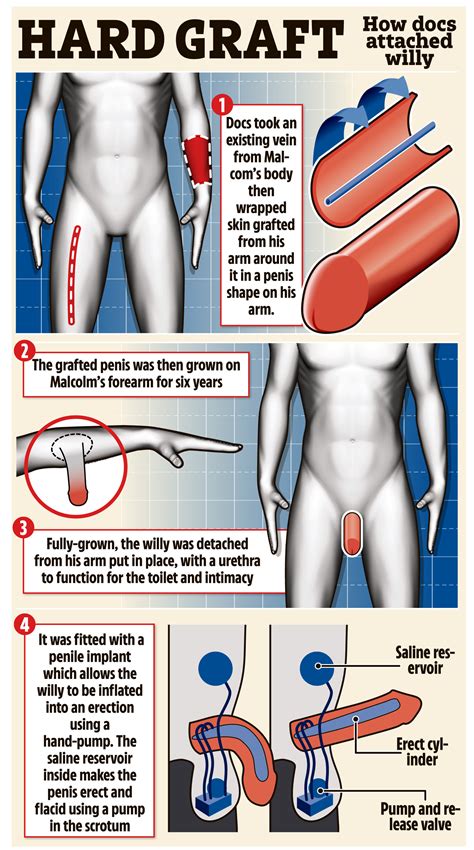 I Ve Had A Penis On My Arm For Six Years Now It S Been Fitted I Finally Feel Like A Real Man