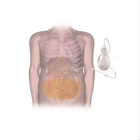 Straight Single Plastic Bd Pleurx Catheter System At Best Price In Gurgaon
