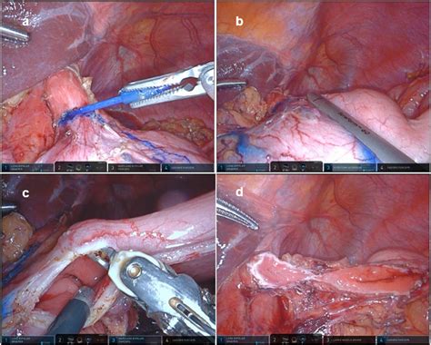 Super Subtotal Gastrectomy A Novel Reconstruction Concept For Upper