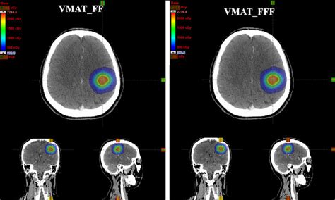 Dose Distributions For One Patient With Single Brain Metastasis In Download Scientific Diagram