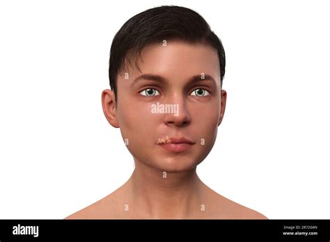 Cold Sore On The Lip Of A Teenage Boy Computer Illustration Cold