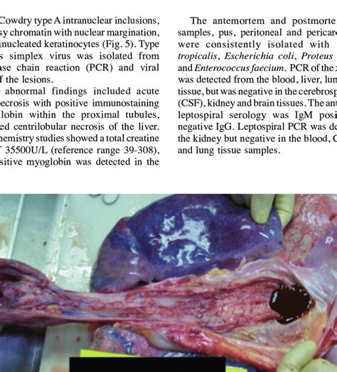 Pseudohyphae Of Candida Tropicalis Grocott Methenamine Silver Stain Download Scientific