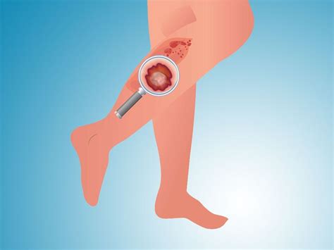 Learn How To Provide Treatment For Pyoderma Gangrenosum Discover Various Treatment Options