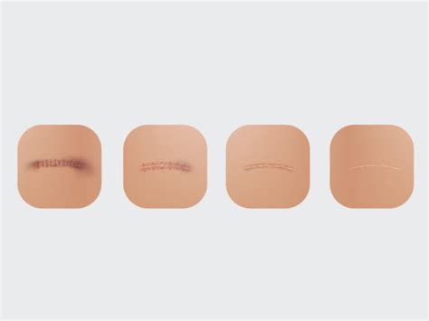 Cicatriz De Abdominoplastia Cuidados Dream Plastic