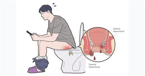Internal Vs External Hemorrhoids Whats The Difference