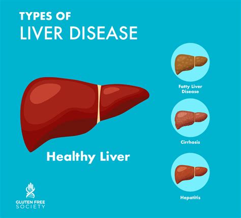 Hepatitis Liver Vs Healthy Liver