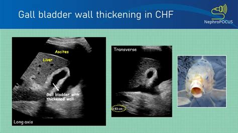 Thickened Gall Bladder Wall Not Always Acute Cholecystitis Nephropocus
