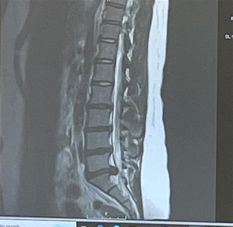 Herniated Disc Mri L5