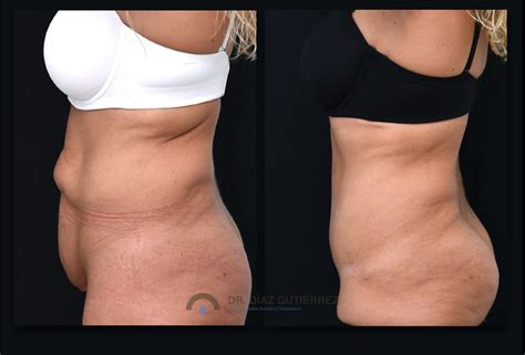 Atmósfera Paso Libertad Abdominoplastia Fotos Reales En Particular