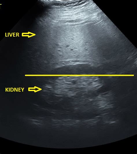 Ultrasound Images Of Fatty Liver