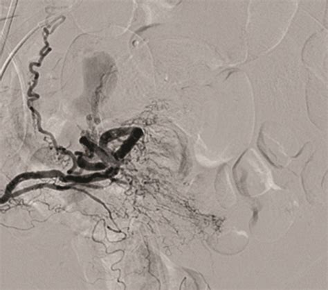 Endovascular Today Embolization Of A Large Uterine Fibroid April 2017