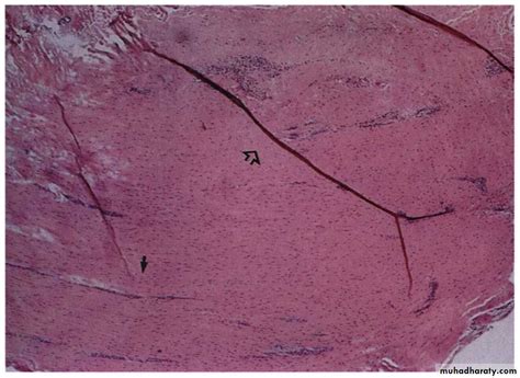Shoulder Instablity Pptx وحيد Muhadharaty