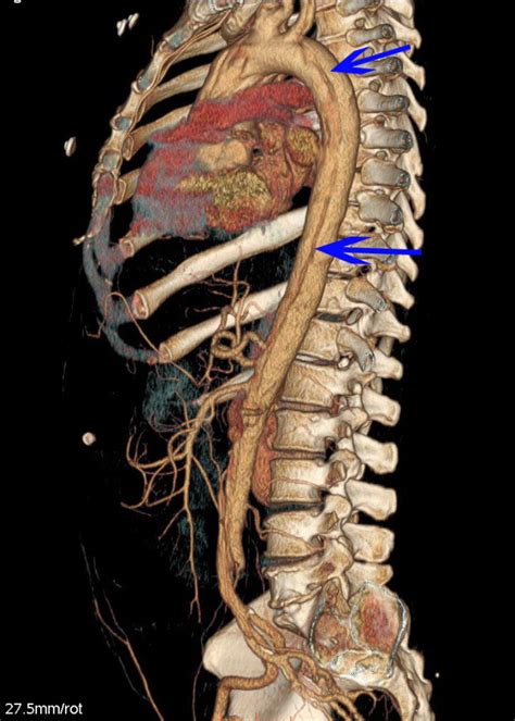 Aneurisma de la aorta torácica como se diagnostíca