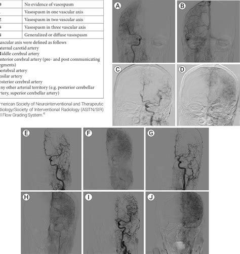 Figure 1 From The Impact Of Collateral Status On Cerebral Vasospasm And
