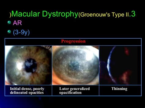 Corneal Dystrophies By Dr Safaa Refaat