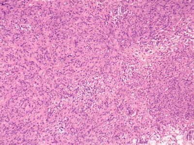 Gastrointestinal Estromal Tumor GIST The Gastrointestinalatlas Gastrointestinalatlas Com