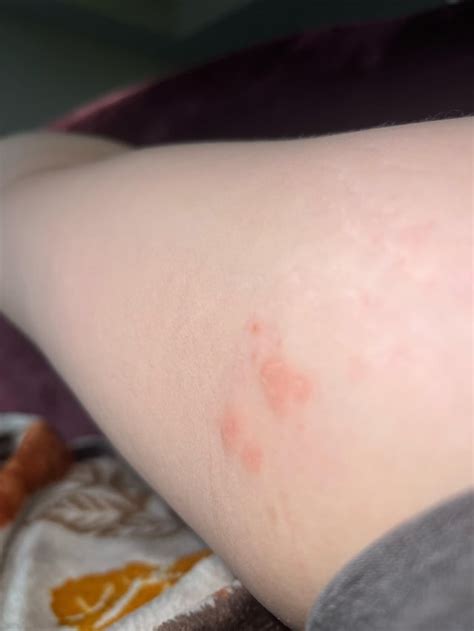Spider Bite Near Armpit Rbugbites
