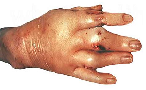 A Picture Of Gout Affected Hand With Inflammation