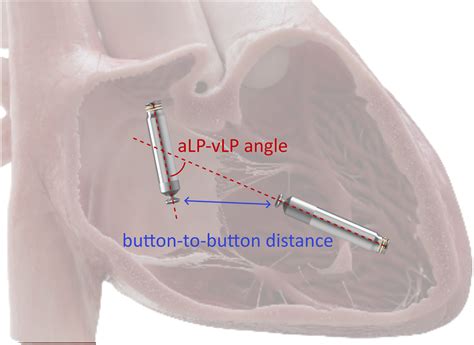 Implantation Techniques For A Helix Fixation Dual Chamber Leadless