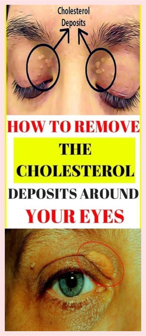 Causes And Natural Remedies For Cholesterol Deposits Around The Eyes