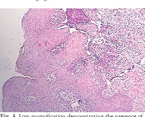 Figure 1 From Pyostomatitis Vegetans Report Of A Rare Case Semantic Scholar