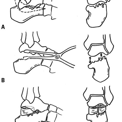 A Talo Calcaneal Height B Talo Calcaneal Angle C Talar Declination Download Scientific