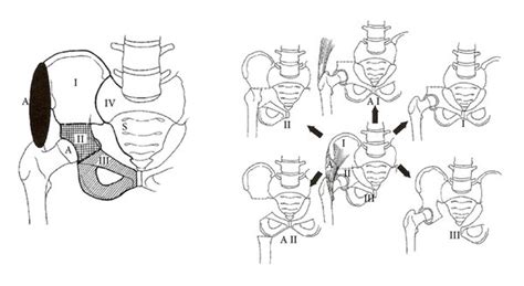 A Classification Of Pelvic Resection 5 Download Scientific Diagram