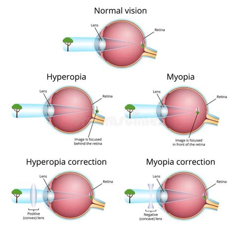Visual Defects Myopia Hyperopia And Astigmatism Hoodoo Wallpaper