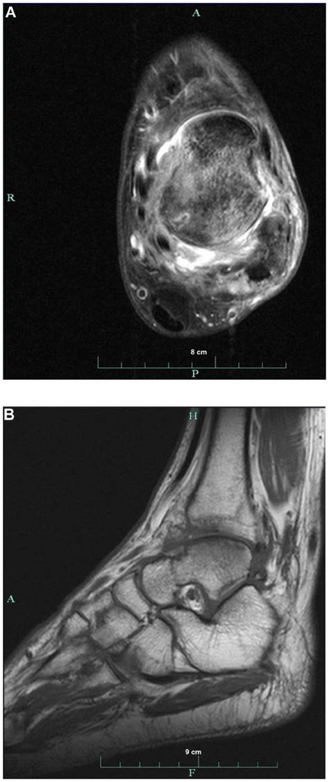 Closed Anterolateral Total Talar Dislocation A Case Report And Techni Orr