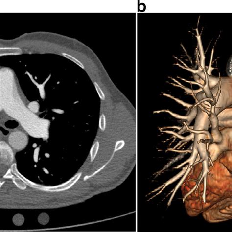 Axial 2d Fiesta Shows Dilated Parametrial Veins Up To 2 Cm Arrow On Download Scientific