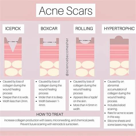 The Main Types Of Acne Scars Are Absolute Shine Clinic Facebook