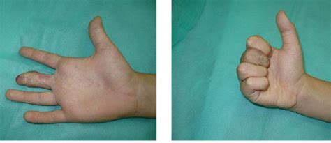 The Result Achieved After Surgical Treatment Of Metacarpal Hand And