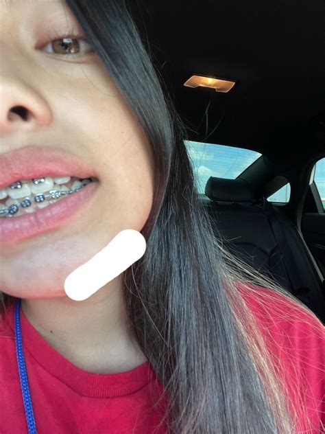 Pin By Zar On Accessoires Perfect Teeth Braces Colors Getting Braces