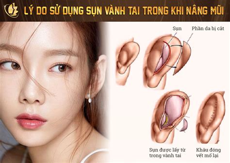 Nâng Mũi Tại Sao Phải Lấy Sụn Tai Tmv Quốc Tế Vip