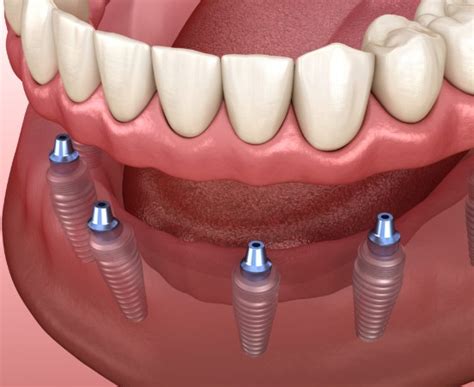Lower Denture Problems And Solutions Skyrise Dental Clinic