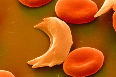 How Sickle Cell Carriers Fend Off Malaria New Scientist