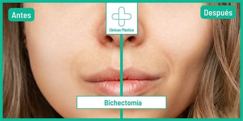 Bichectomía Clinicas Cirugía Plástica