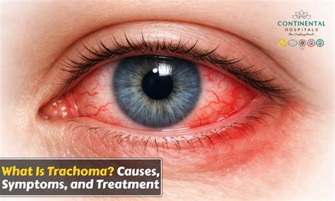 Idiopathic Pulmonary Fibrosis Ipf Causes Symptoms And Treatment