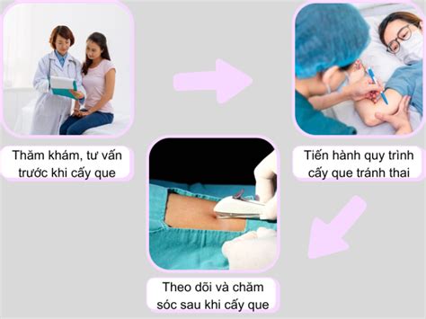Quy Trình Cấy Que Tránh Thai Như Thế Nào