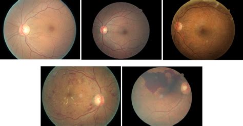 Table 1 From Feature Visualisation Of Classification Of Diabetic Retinopathy Using A