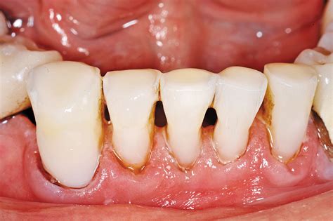 How To Manage Exposed Dentin A Great Patient Service
