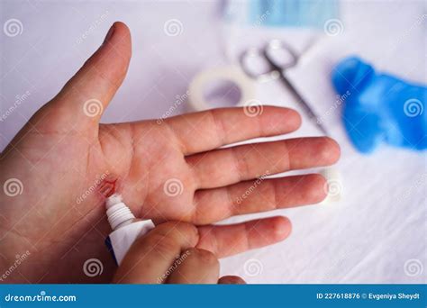 Young Man Hand Applying Medical Ointment On Thumb After Burn Corns And