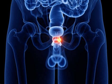 Causes And Prevention Of Prostatitis