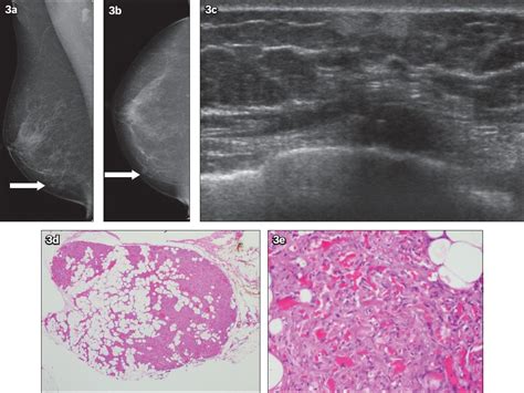 Four Cases Of Echogenic Breast Lesions A Case Series And Review Smj
