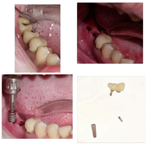 Dental Implants Vinsmiles Advanced Dentistry