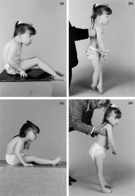 Figure 5 From Classiﬁcation Of Gait Patterns In Spastic Hemiplegia And