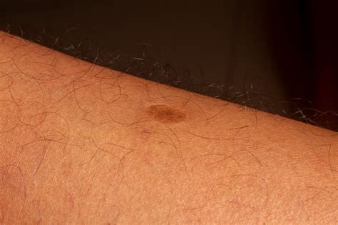 인간의 피부 질감 피부 마이크로 사진에 편평한 사마귀 사진을 닫습니다 갈색에 대한 스톡 사진 및 기타 이미지 갈색 건강
